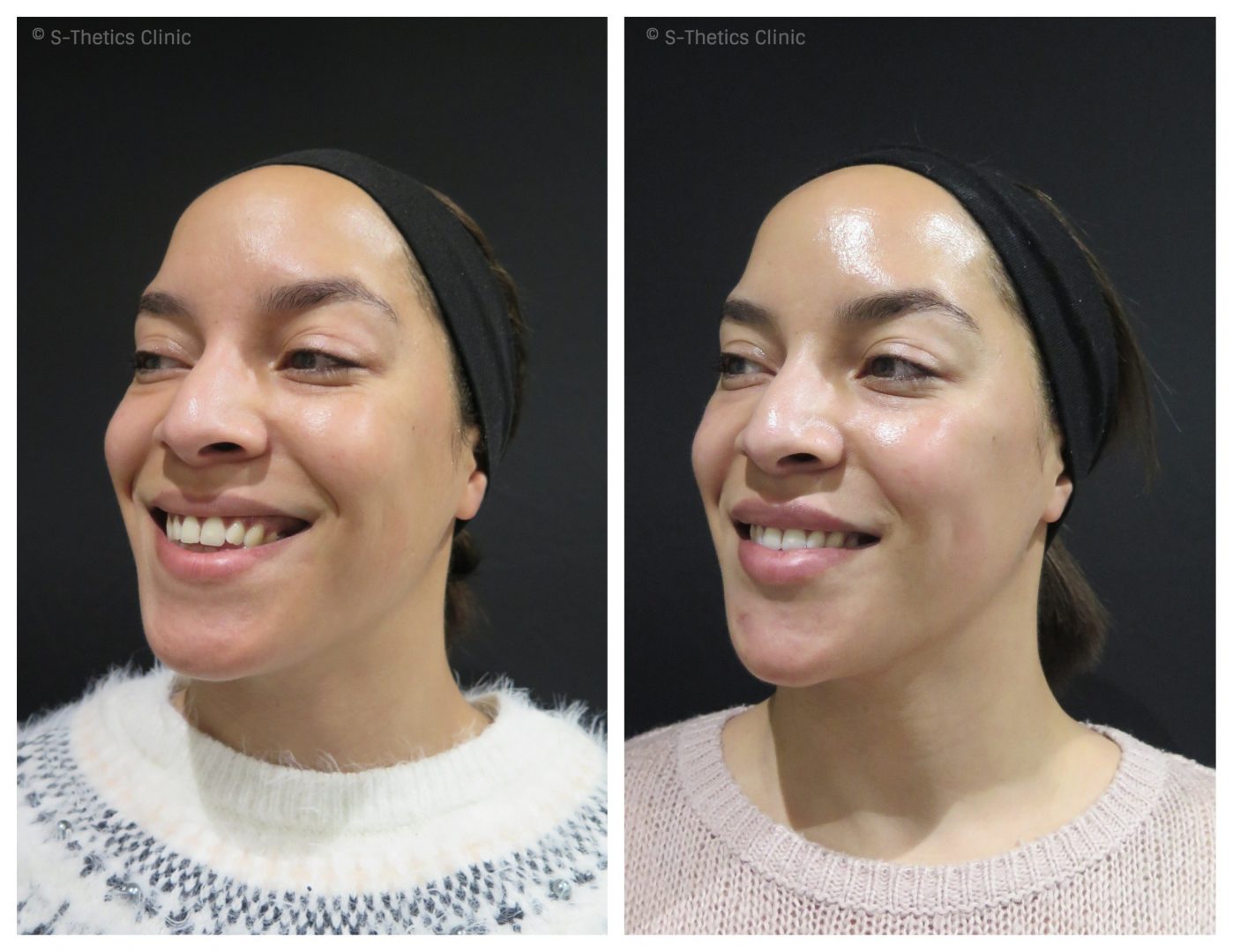 Patient Success Story - treating identical twins with Juvederm Volux ...