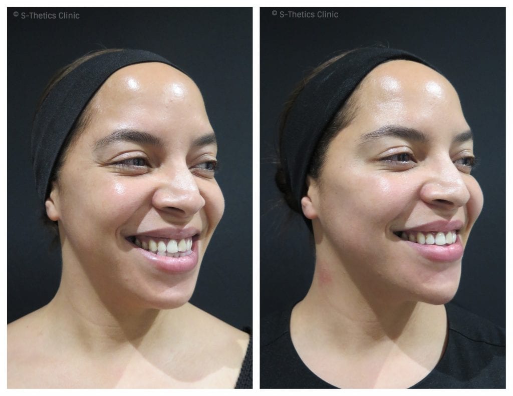 Patient Success Story - treating identical twins with Juvederm Volux ...