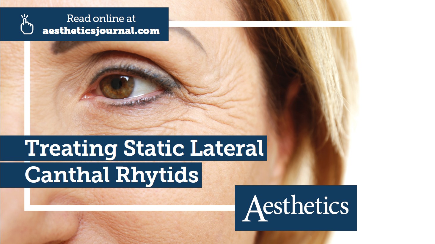 Aesthetics Journal Expert Opinion - Treating Static Lateral Canthal ...